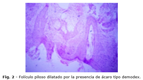 Dermatitis de contacto versus demodicidiosis | Pérez López | Folia ...
