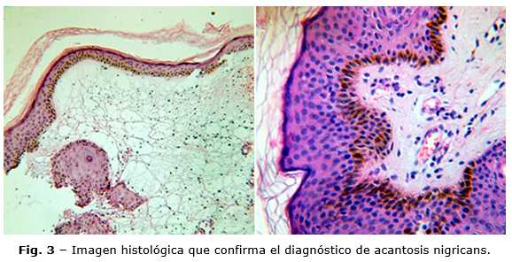 Histologia Da Acantose Nigricans Unilateral Nevoid Acanthosis