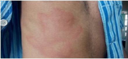 Urticaria a frigore | Silvente Alarcón | Folia Dermatológica Cubana